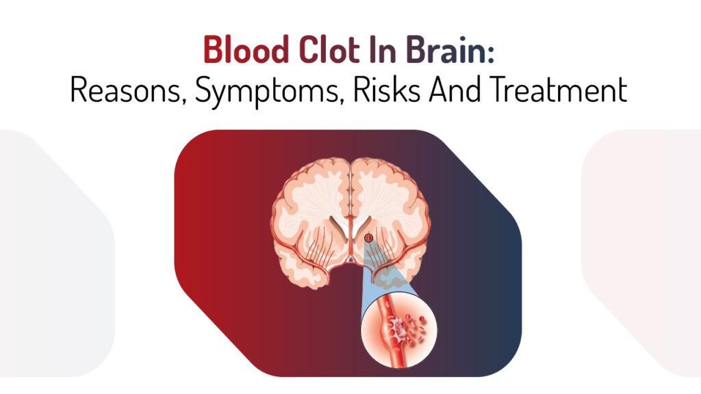 Blood Clot In Brain: Reasons, Symptoms, Risks And Treatment - Sravani ...